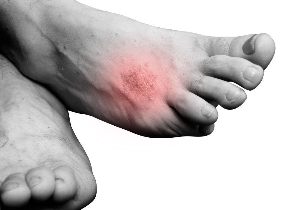 Blog | À propos du psoriasis